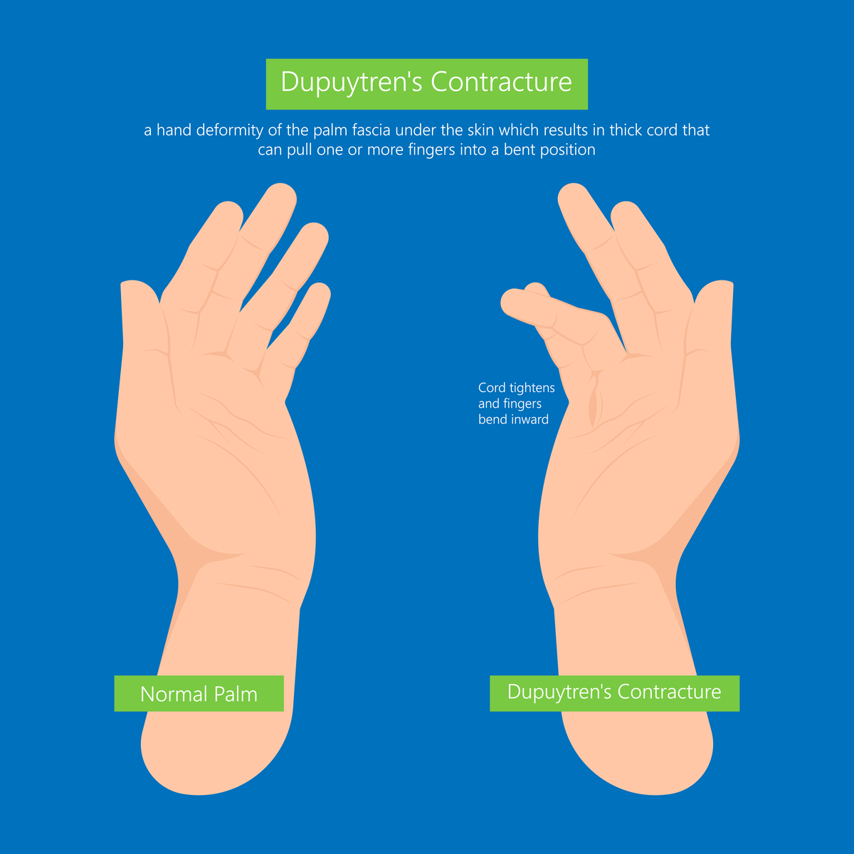 Condition Spotlight: Dupuytren's Contracture by Amy Eckert ...