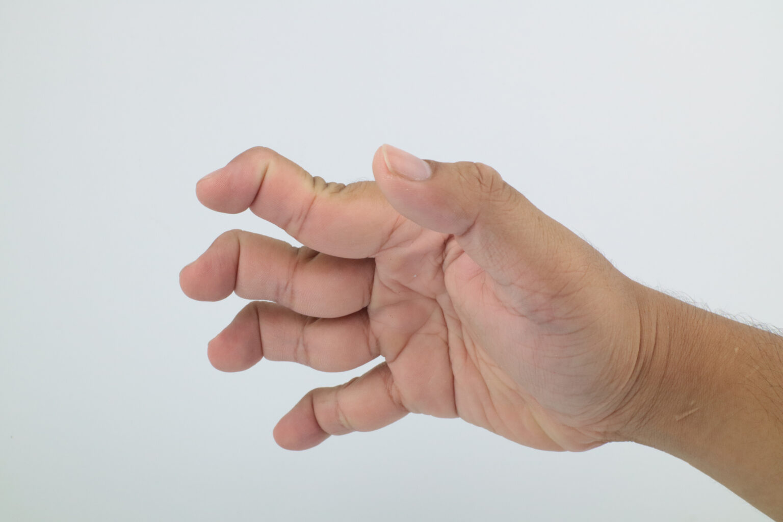 Condition Spotlight: Swan Neck Deformity by Amy Eckert, Occupational ...